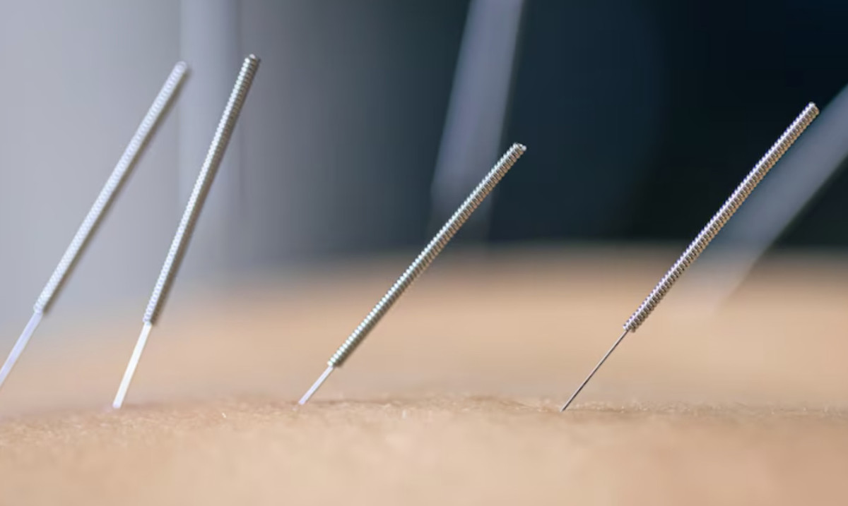 Dry Needling vs. Acupuncture: Understanding the Key Differences | Domier Chiropractic